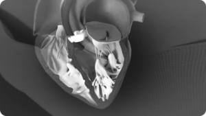 Cardiac - Remodeling the ventricle. Initiating heart recovery